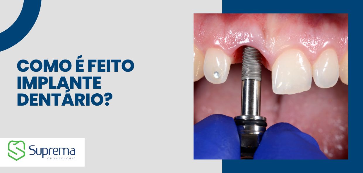 Como é feito Implante Dentário? Entenda o passo a passo